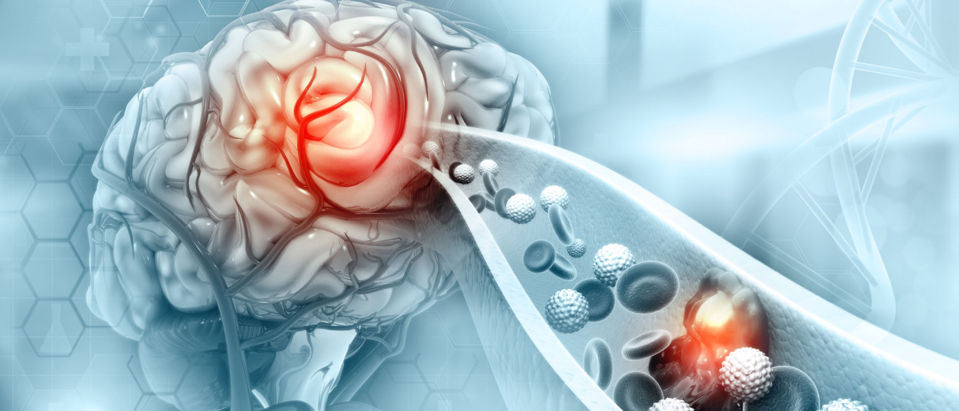 Ictus. Aggiornate le linee guida dell’American Stroke Association - MSD ...