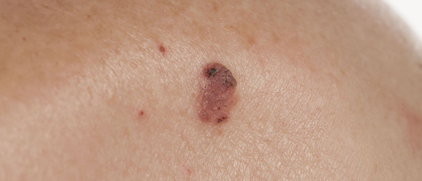 Melanoma. Differenze di genere in base a età e sito di sviluppo - MSD ...