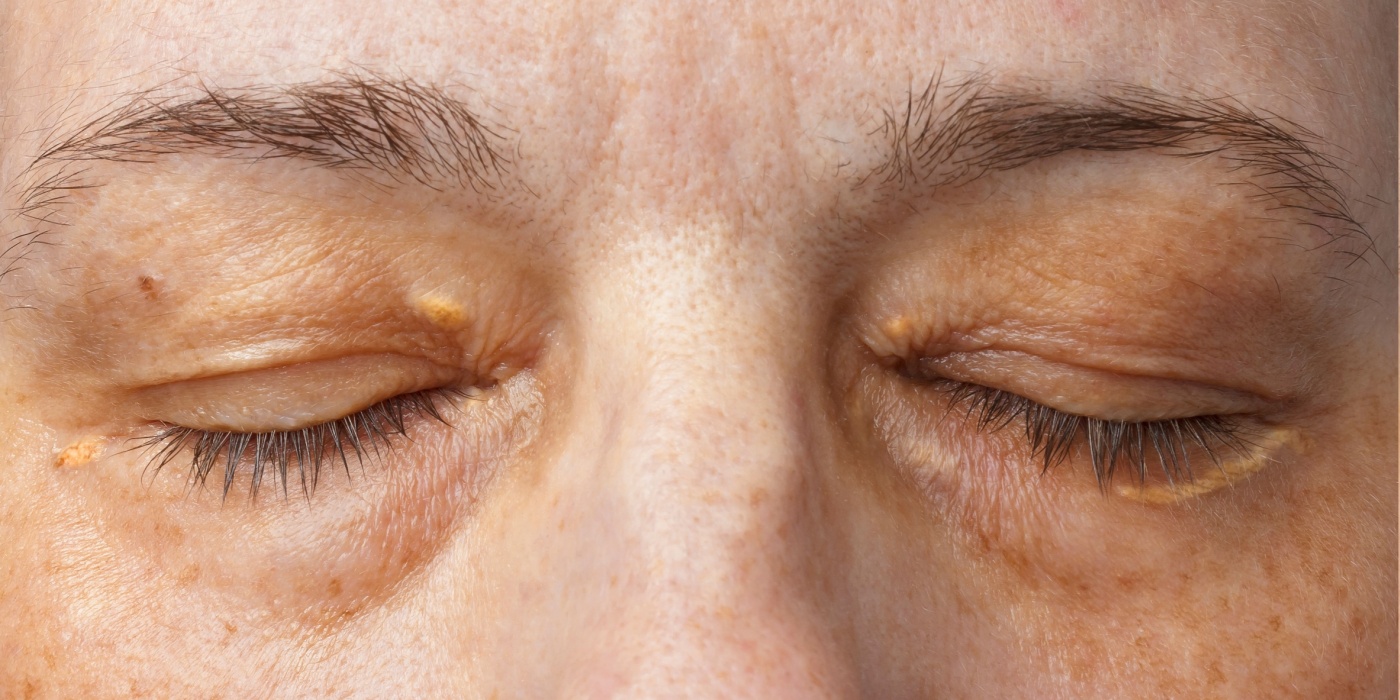 Trattamento del melanoma delle palpebre - MSD | Salute